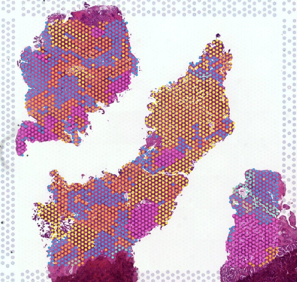 Cellular ‘atlas’ of prostate cancer opens new avenues for earlier ...