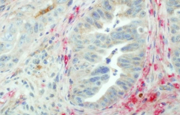 Imaging of a pancreatic cancer tumour and its micro-environment