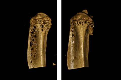 Bone deteriorated by multiple myeloma is regenerated after treatment ...