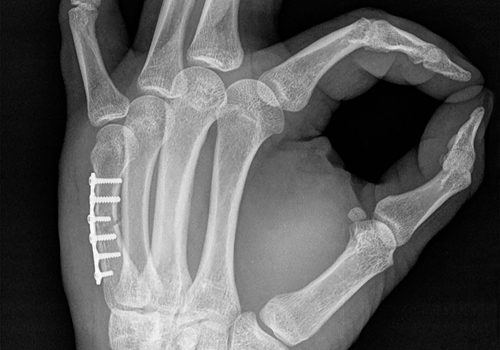 Small Bone Fracture Plates | ASTM