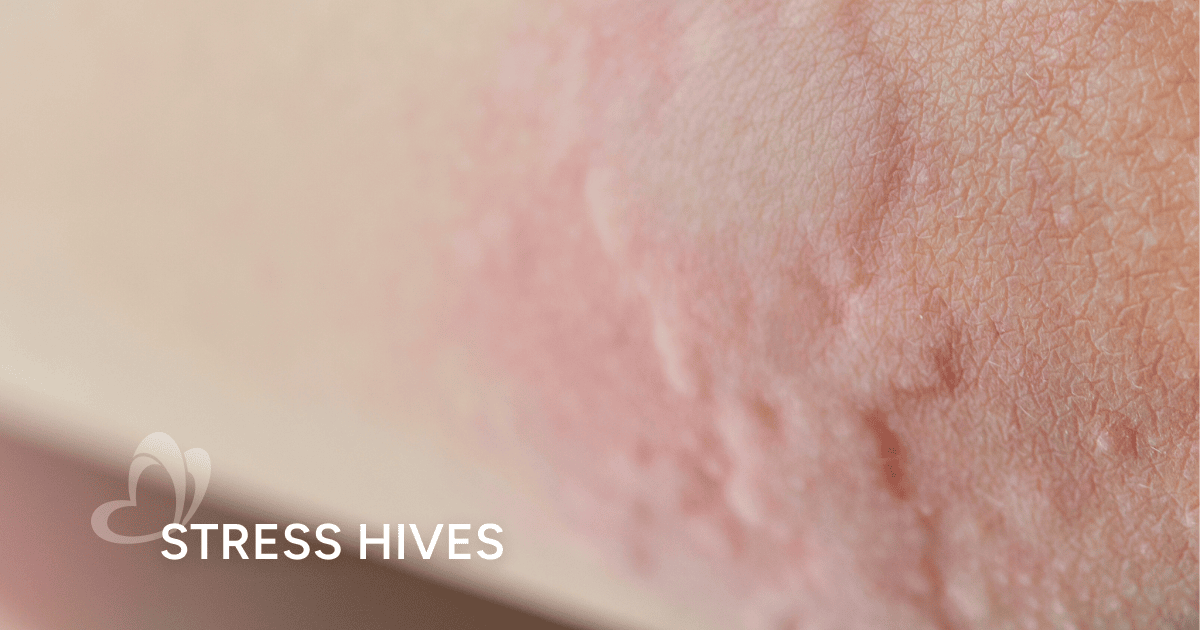 Stress Hives | Thomson Medical