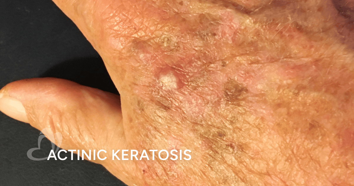 Actinic Keratosis | Thomson Medical