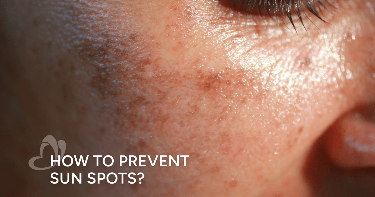 How to Prevent Sun Spots | Thomson Medical