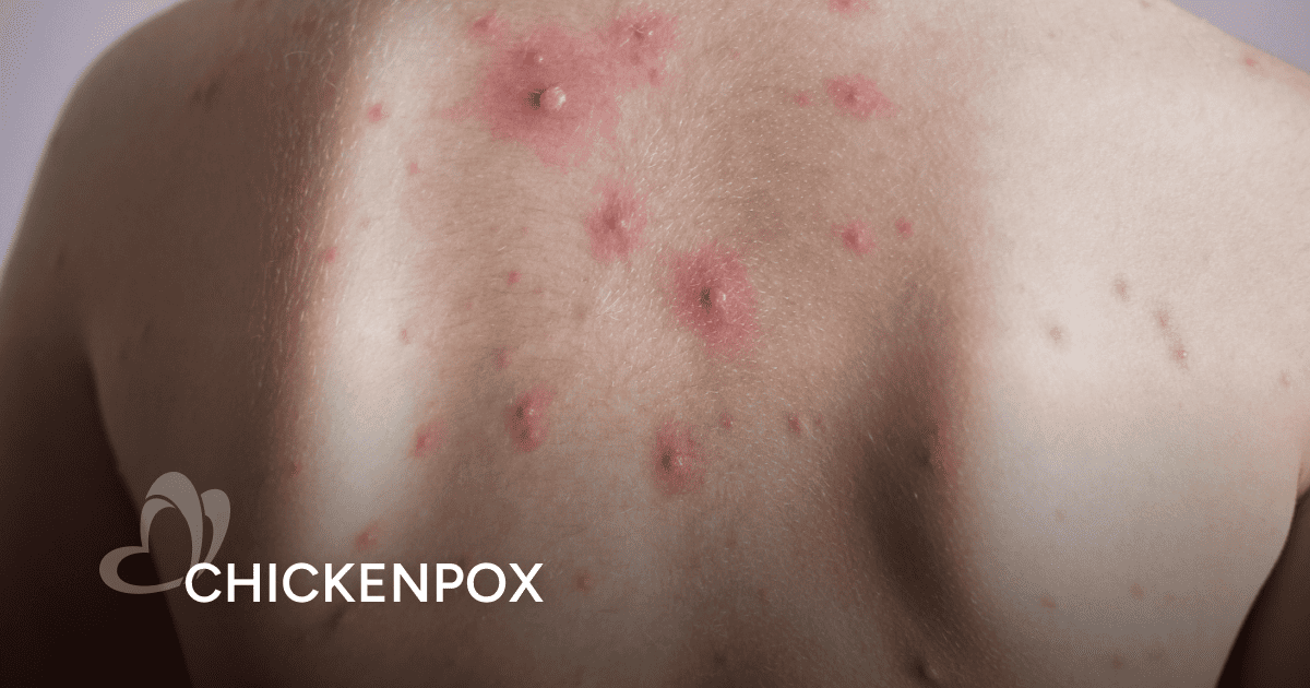 Chickenpox: Symptoms, Treatment, and How to Prevent It | Thomson Medical