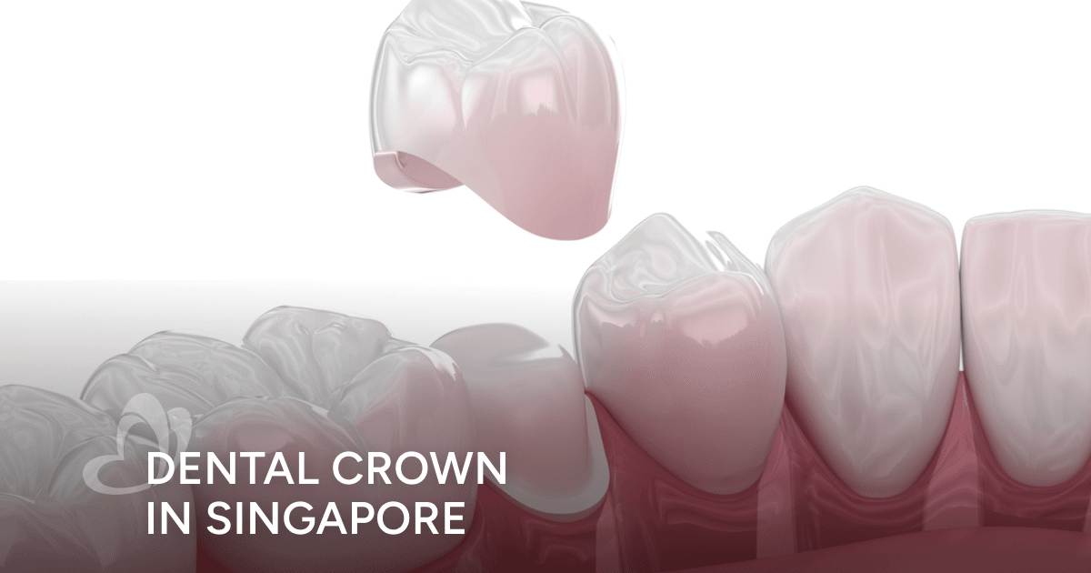 Dental Crown in Singapore | Thomson Medical