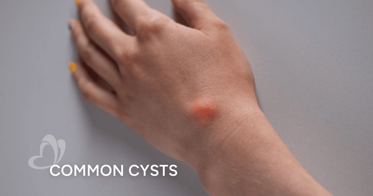 What Are the Most Common Types of Cyst? | Thomson Medical