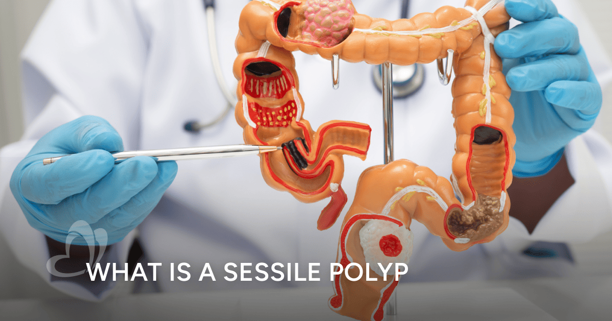What Is a Sessile Polyp? Causes, Risks & Treatment Options | Thomson ...