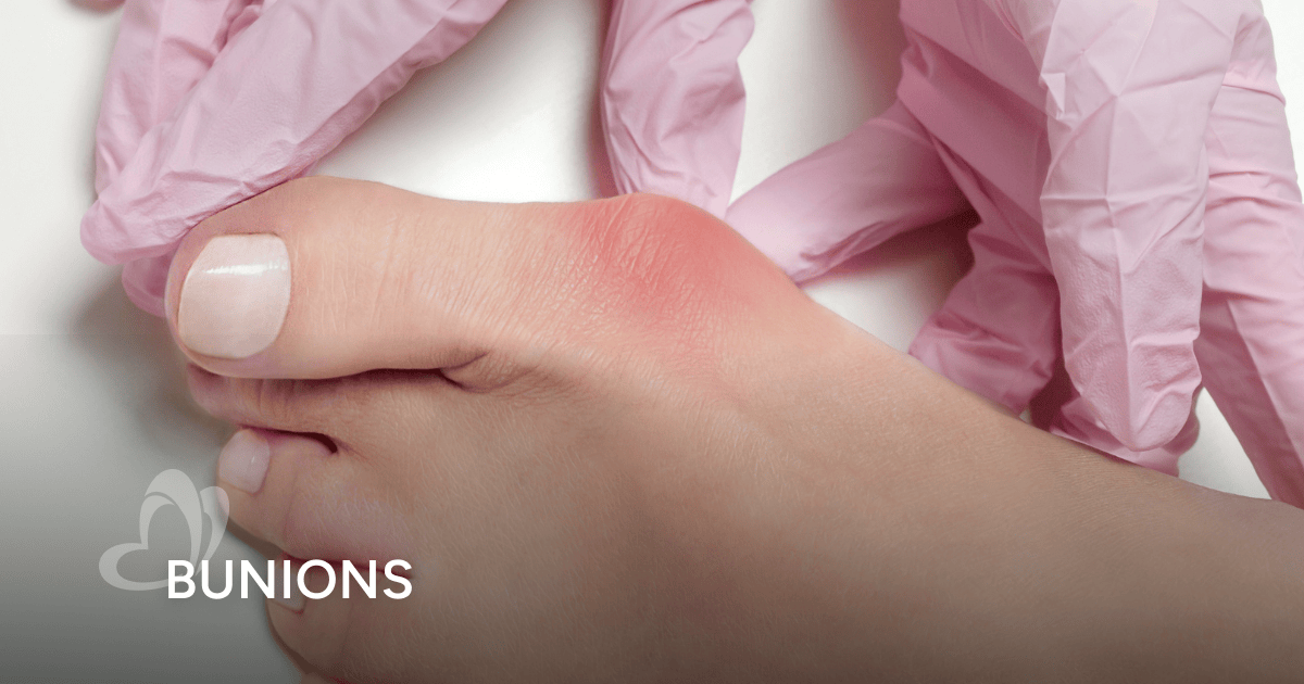 Bunions: Causes, Symptoms, and Treatments | Thomson Medical