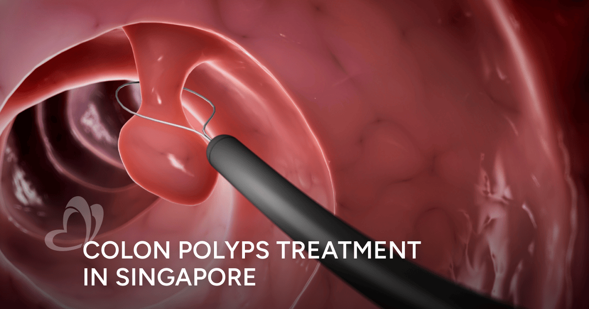 Colon Polyps Treatment in Singapore: What to Expect | Thomson Medical