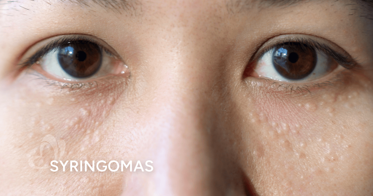 Syringomas | Thomson Medical