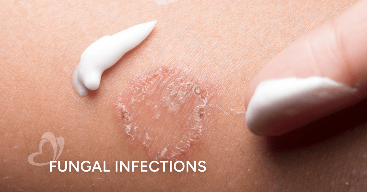 Fungal Infections | Thomson Medical