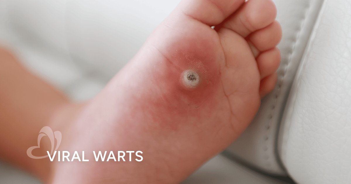 Viral Warts | Thomson Medical