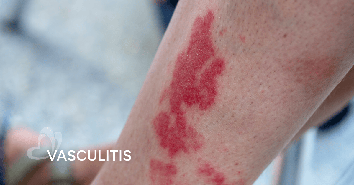 Vasculitis | Thomson Medical