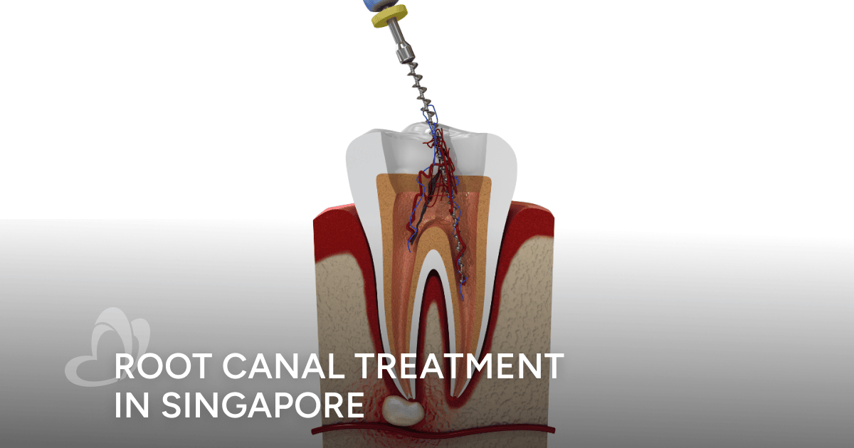 Root Canal Treatment in Singapore | Thomson Medical