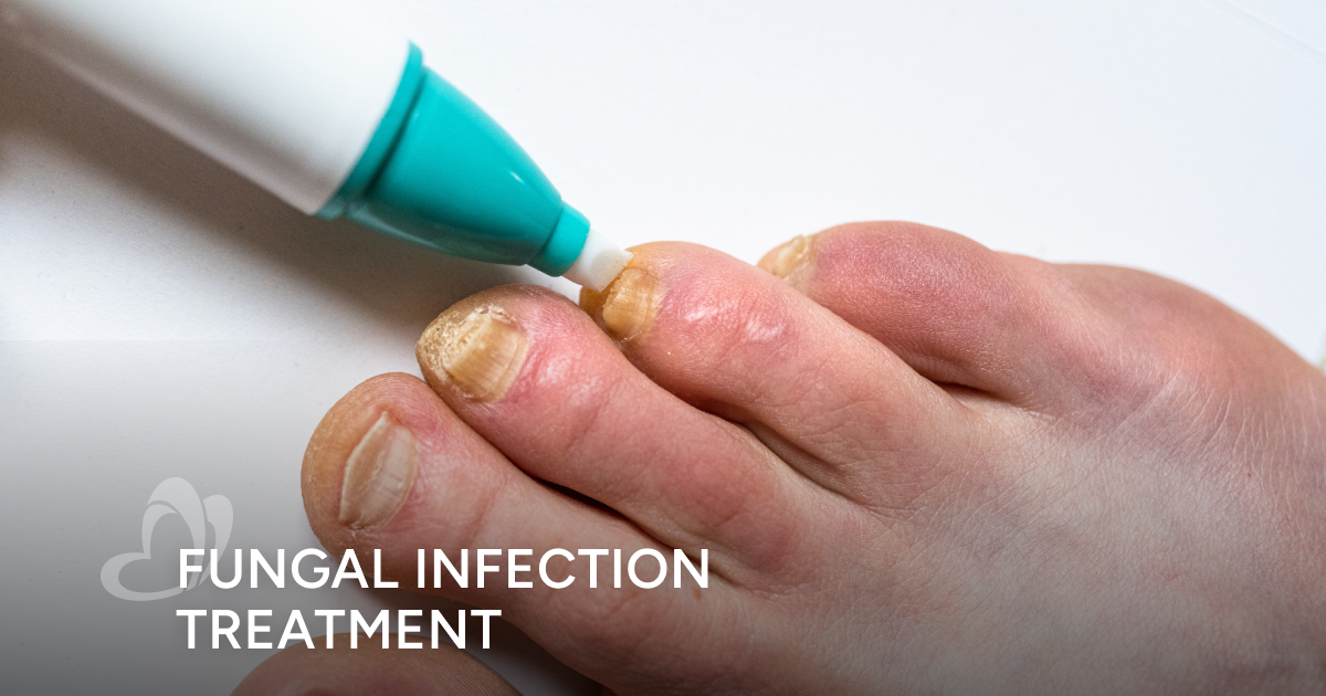 5 Treatments for Fungal Infections | Thomson Medical