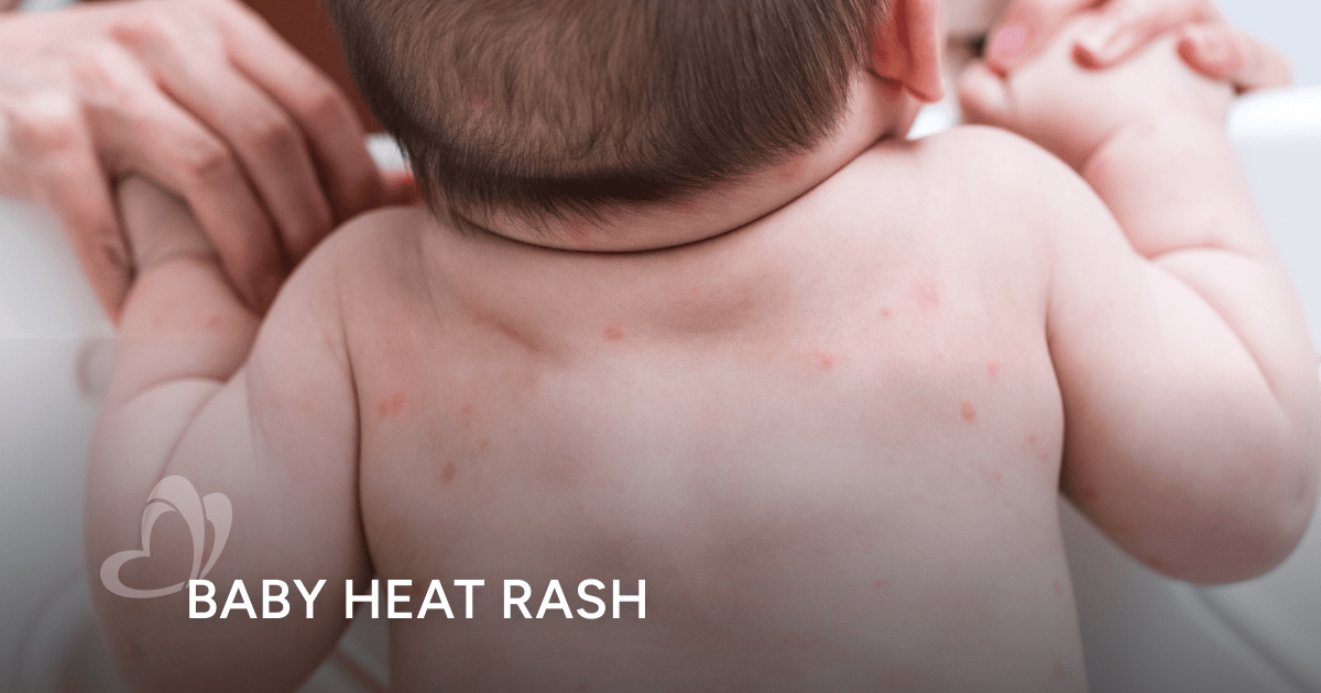 Baby Heat Rash: What It Looks Like and How to Treat It at Home ...