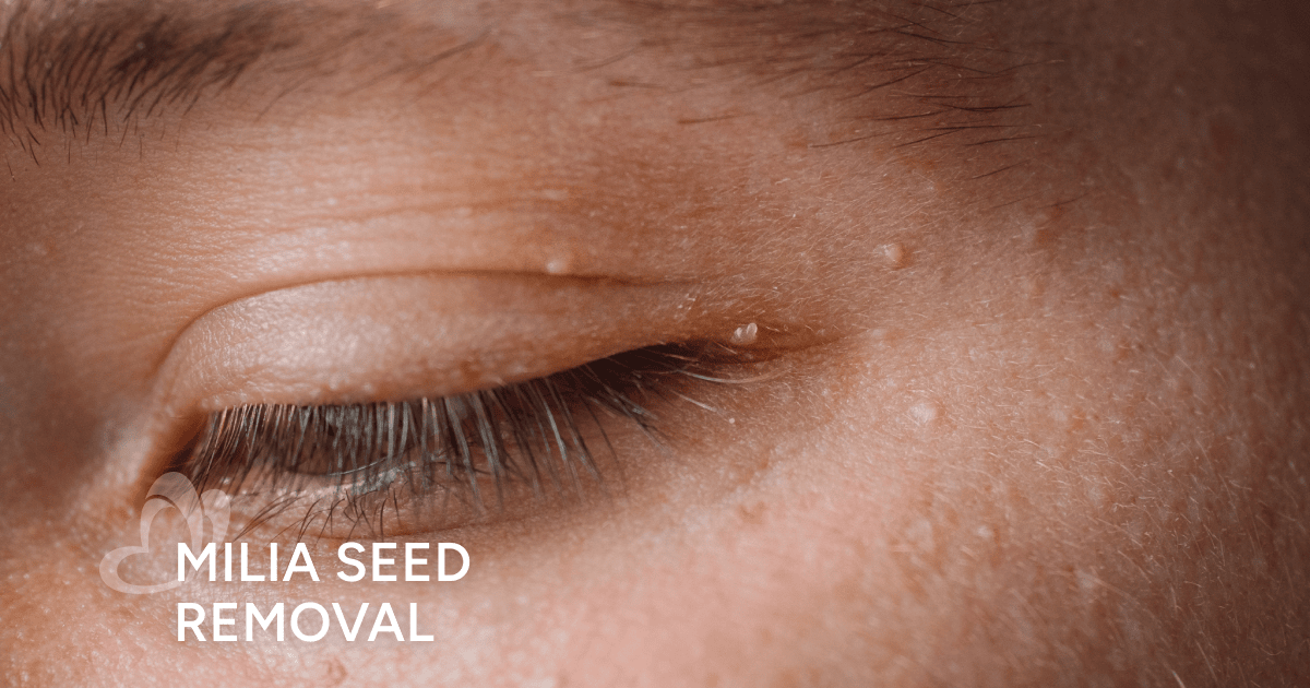 Milia Seed Removal | Thomson Medical