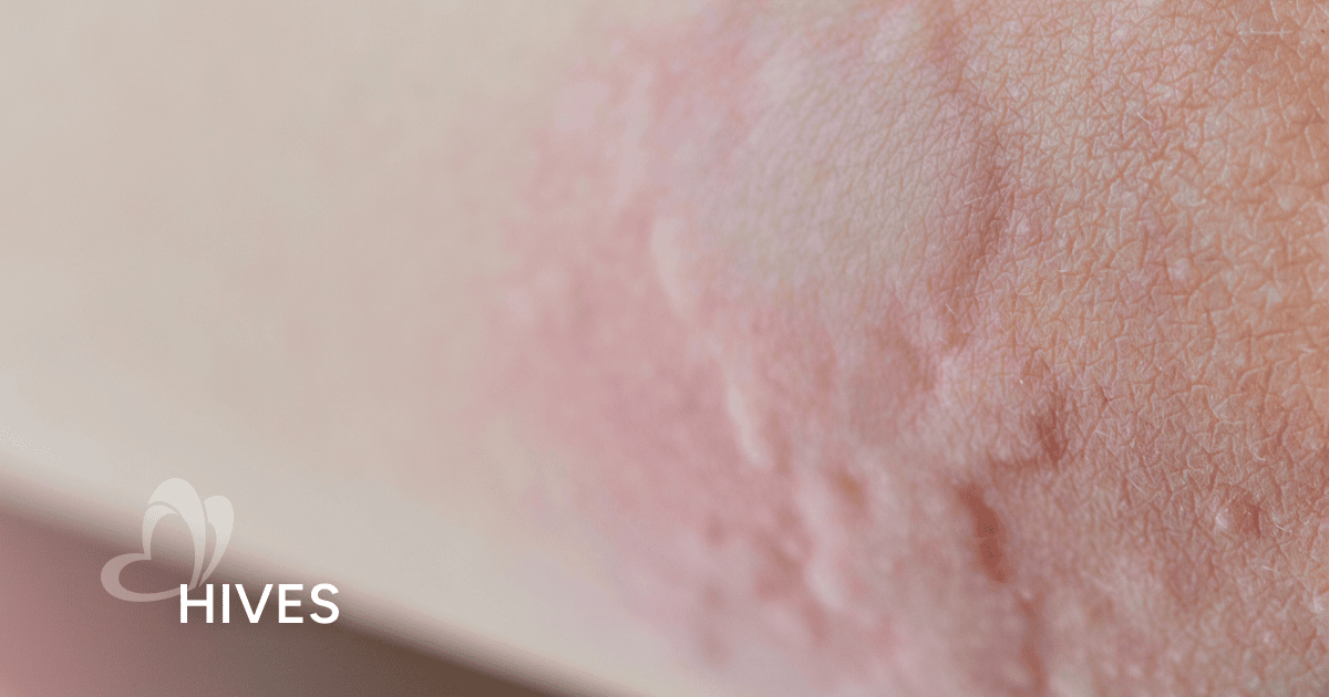 Hives | Thomson Medical