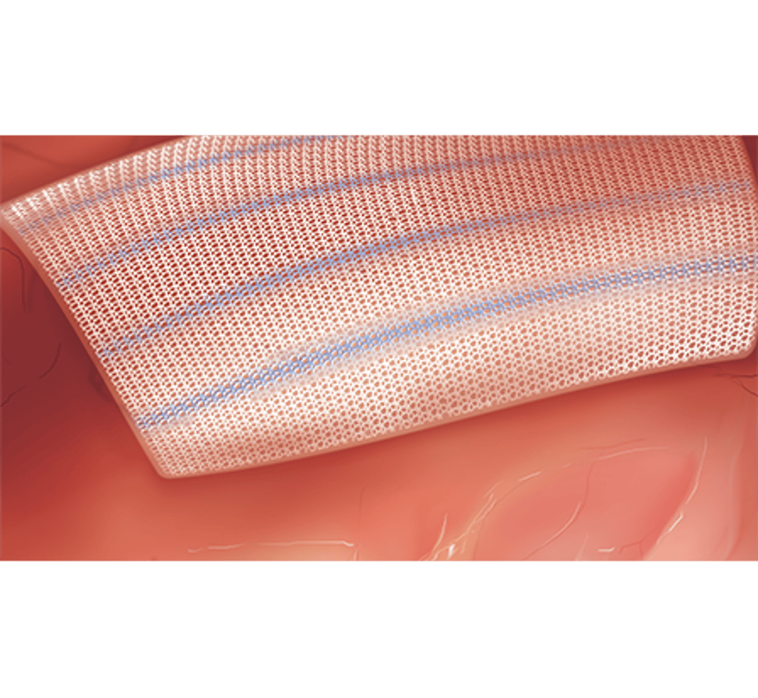PROCEED™ Surgical Mesh | J&J MedTech US