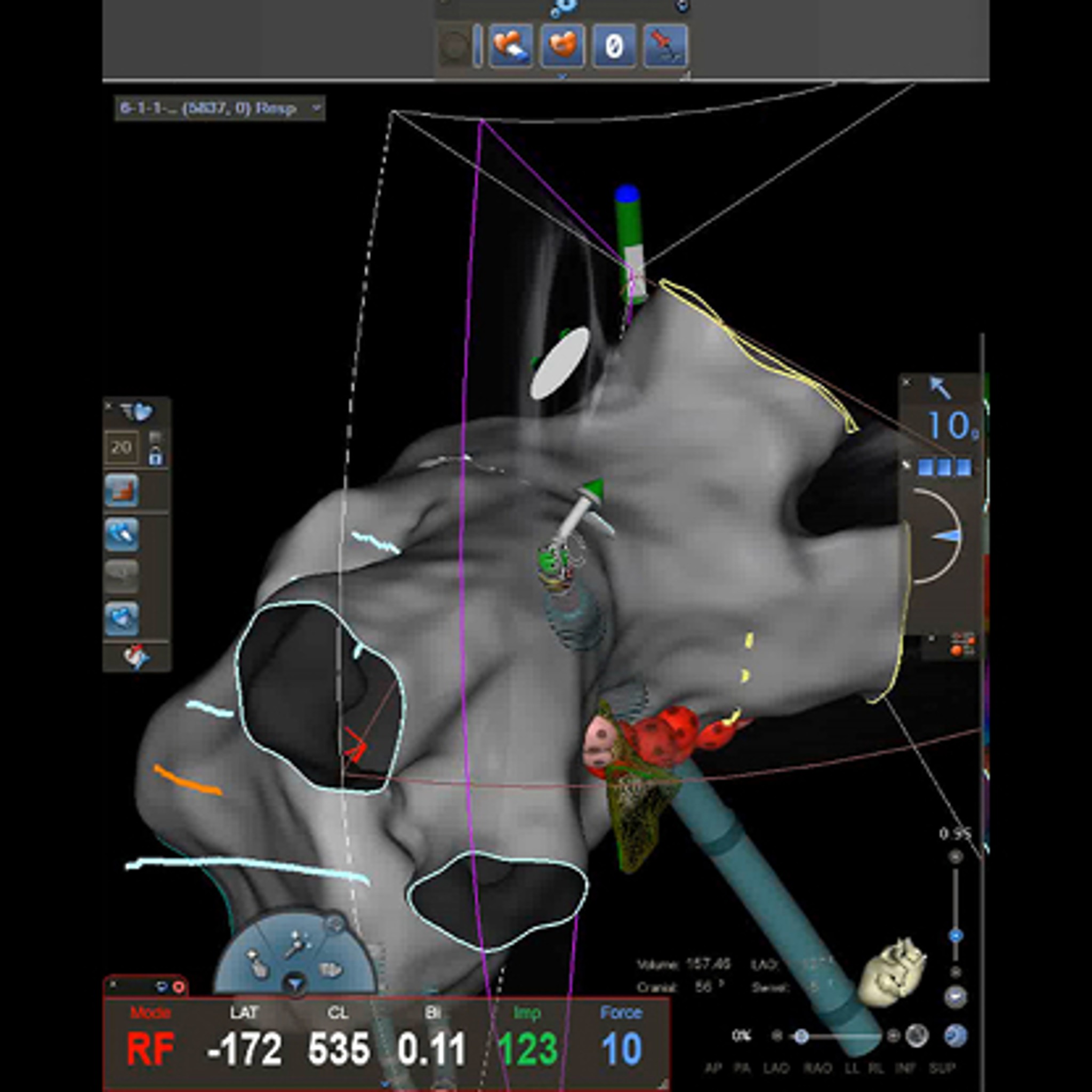 NUVISION™ NAV Ultrasound Catheter | J&J MedTech US