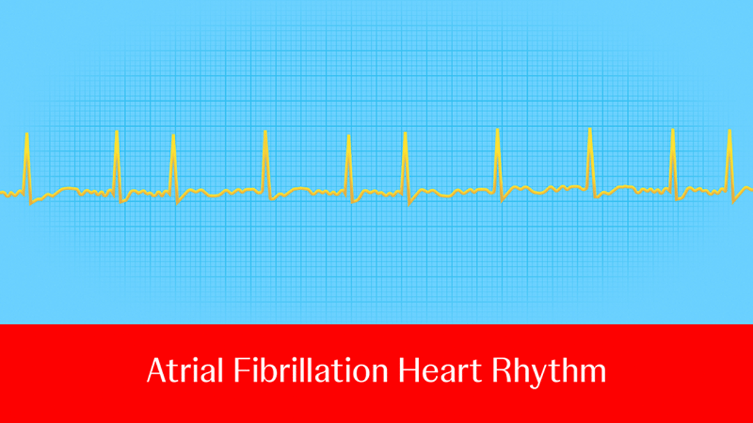 Ask an electrophysiologist: What roles do PFA and RFA play in the ...