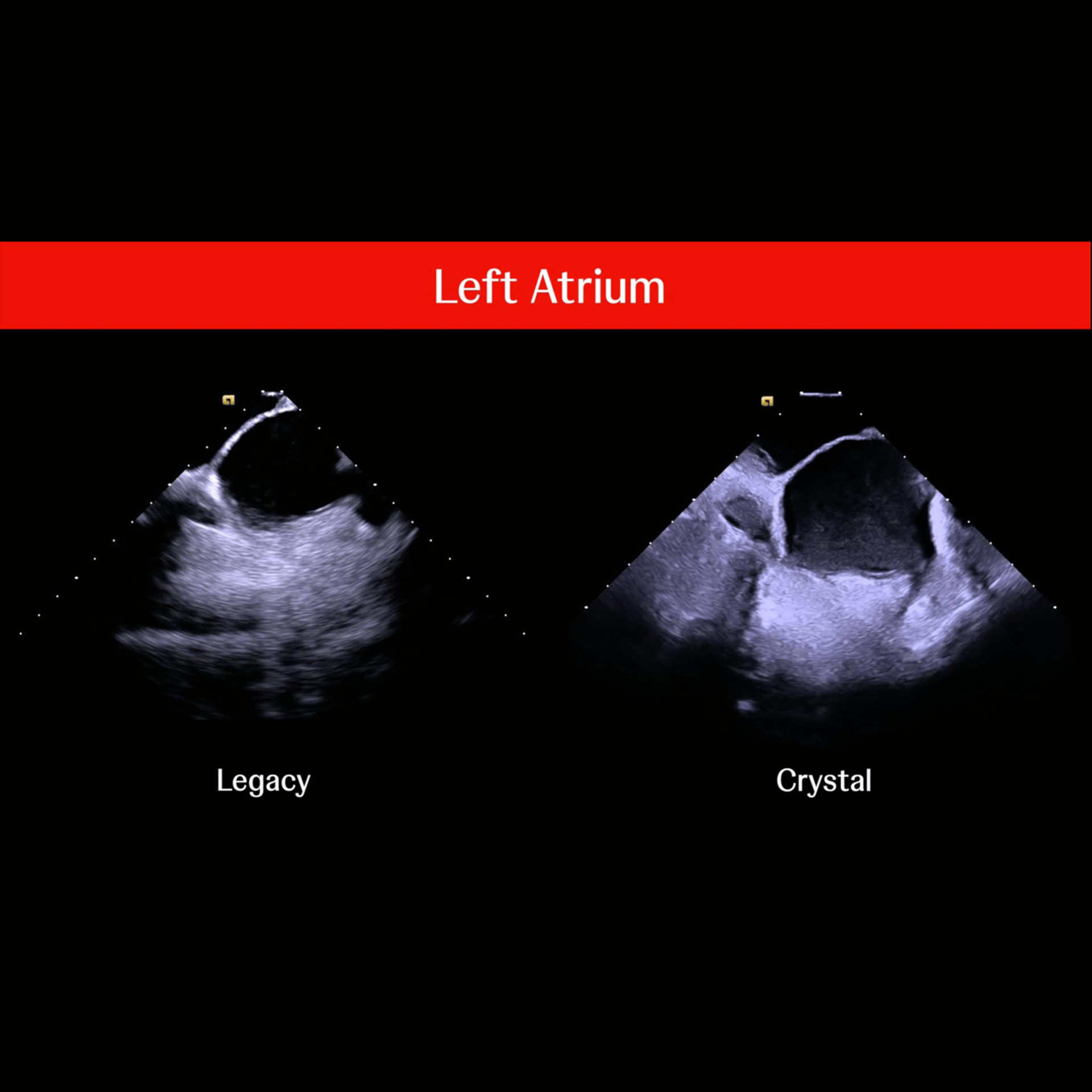 AcuNav CRYSTAL™ Ultrasound Catheter | J&J MedTech US