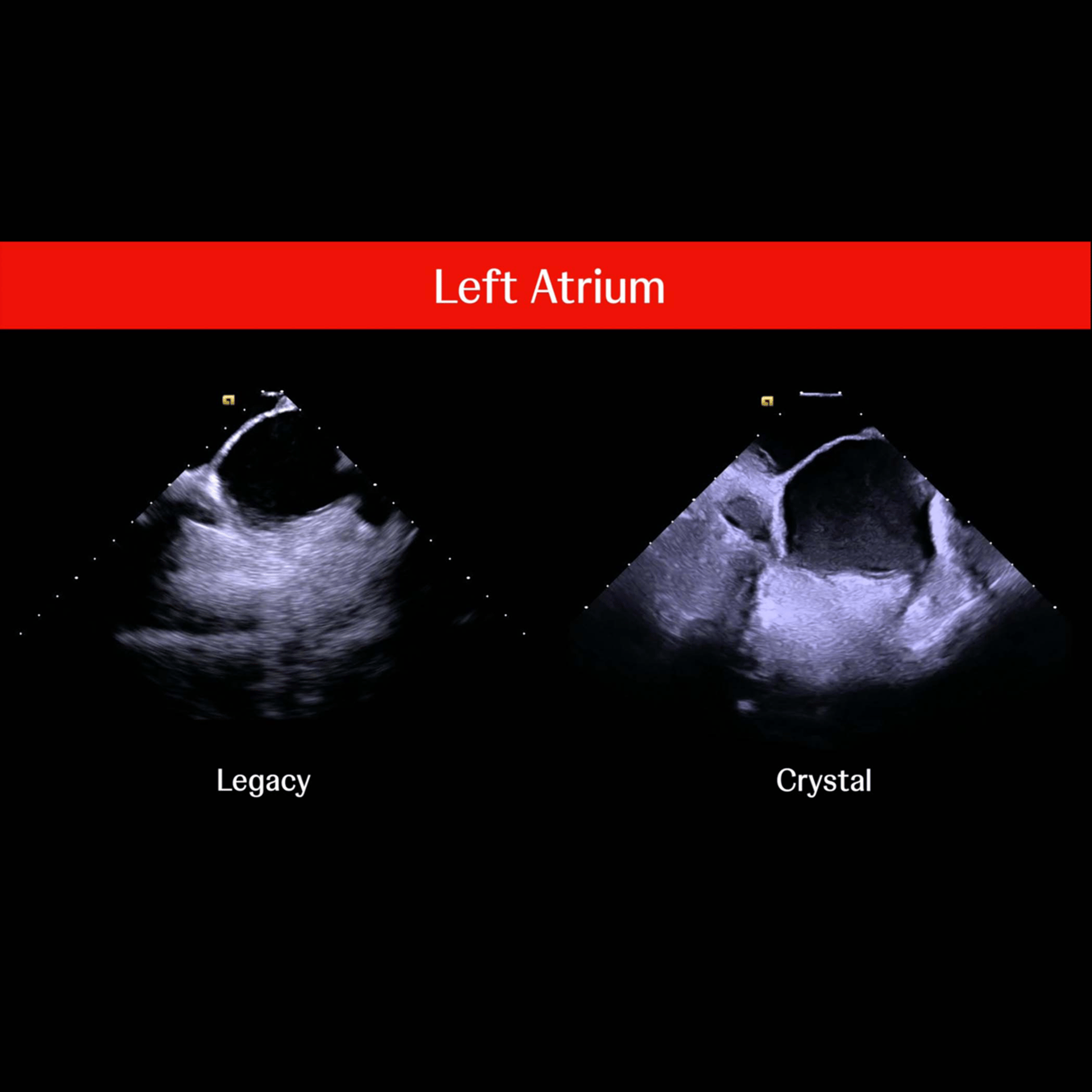 AcuNav CRYSTAL™ Ultrasound Catheter | J&J MedTech US