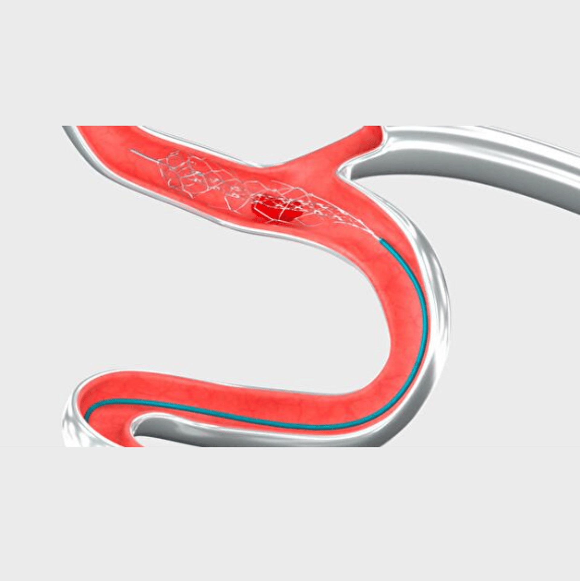 EMBOTRAP® III Revascularization Device | J&J MedTech US
