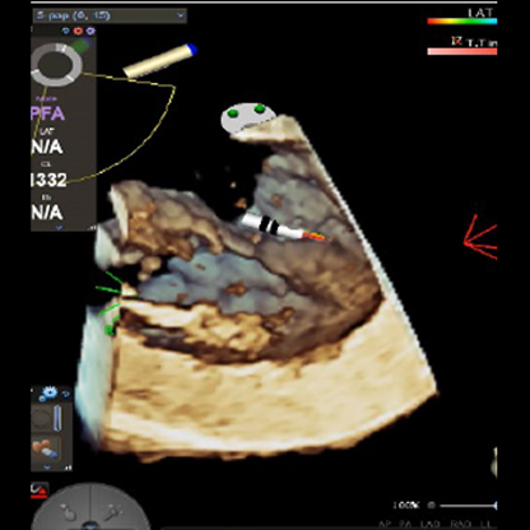 NUVISION™ NAV Ultrasound Catheter | J&J MedTech US