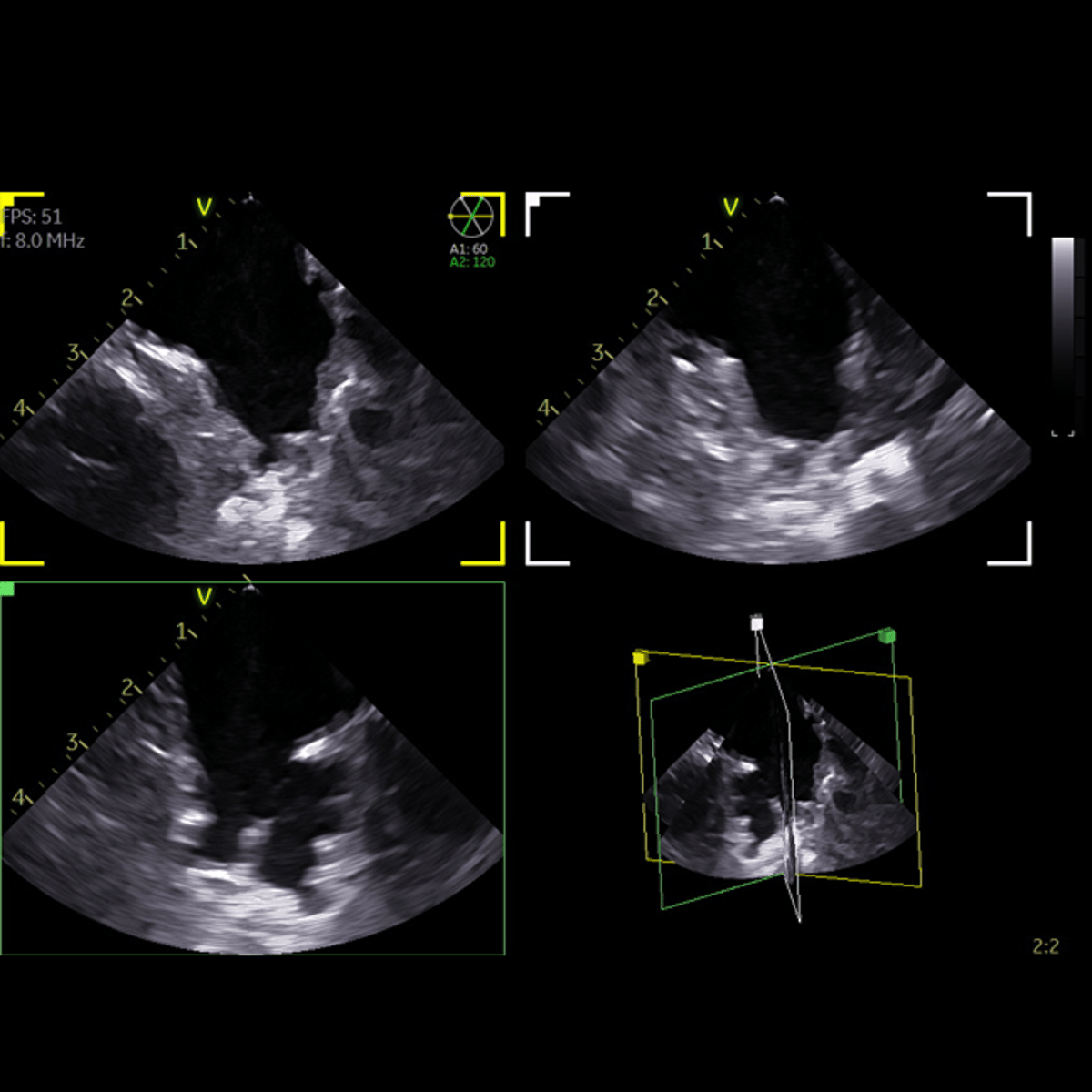 NUVISION™ Ultrasound Catheter | J&J MedTech US