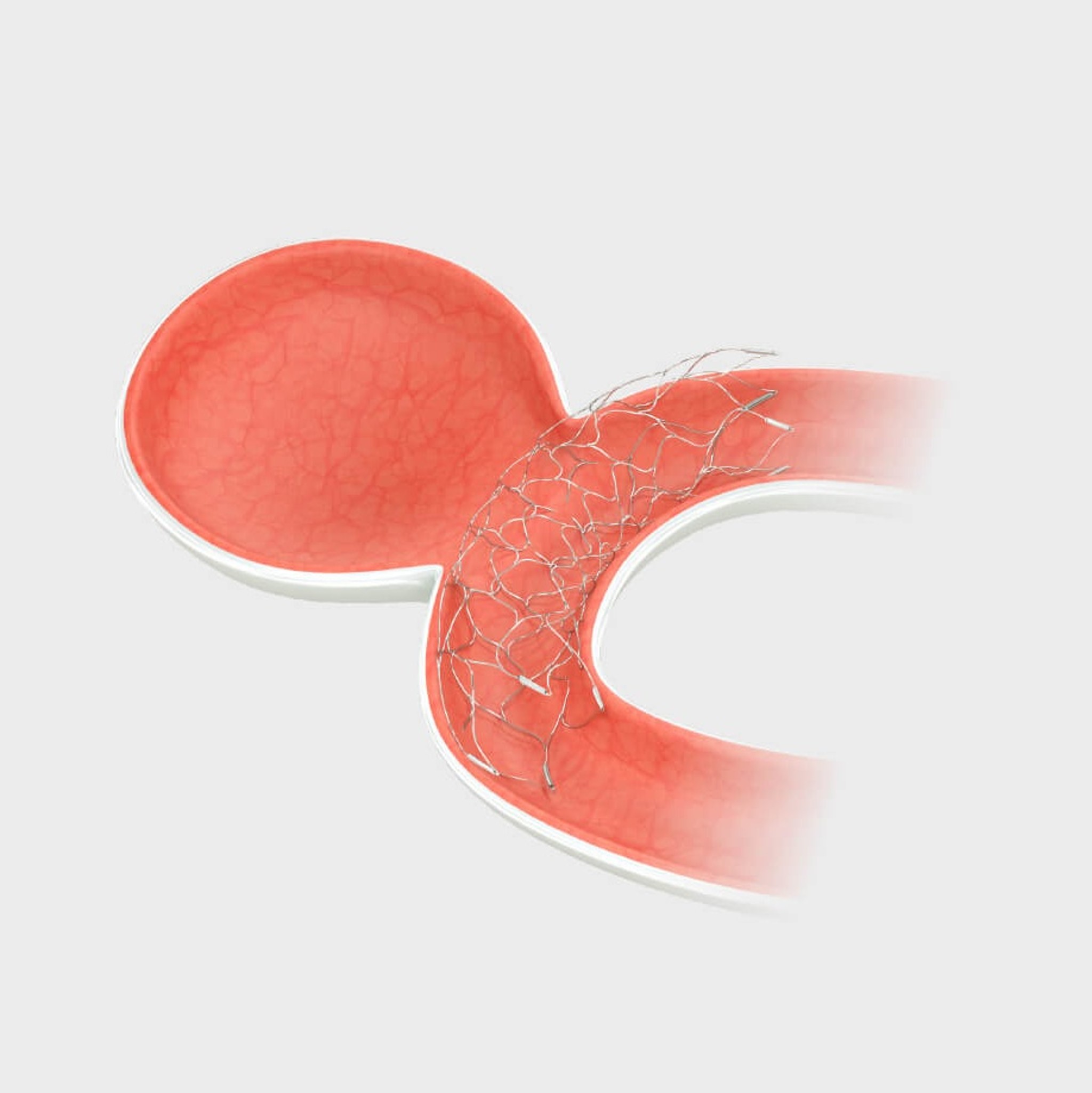 ENTERPRISE™2 Vascular Reconstruction Device | J&J MedTech US