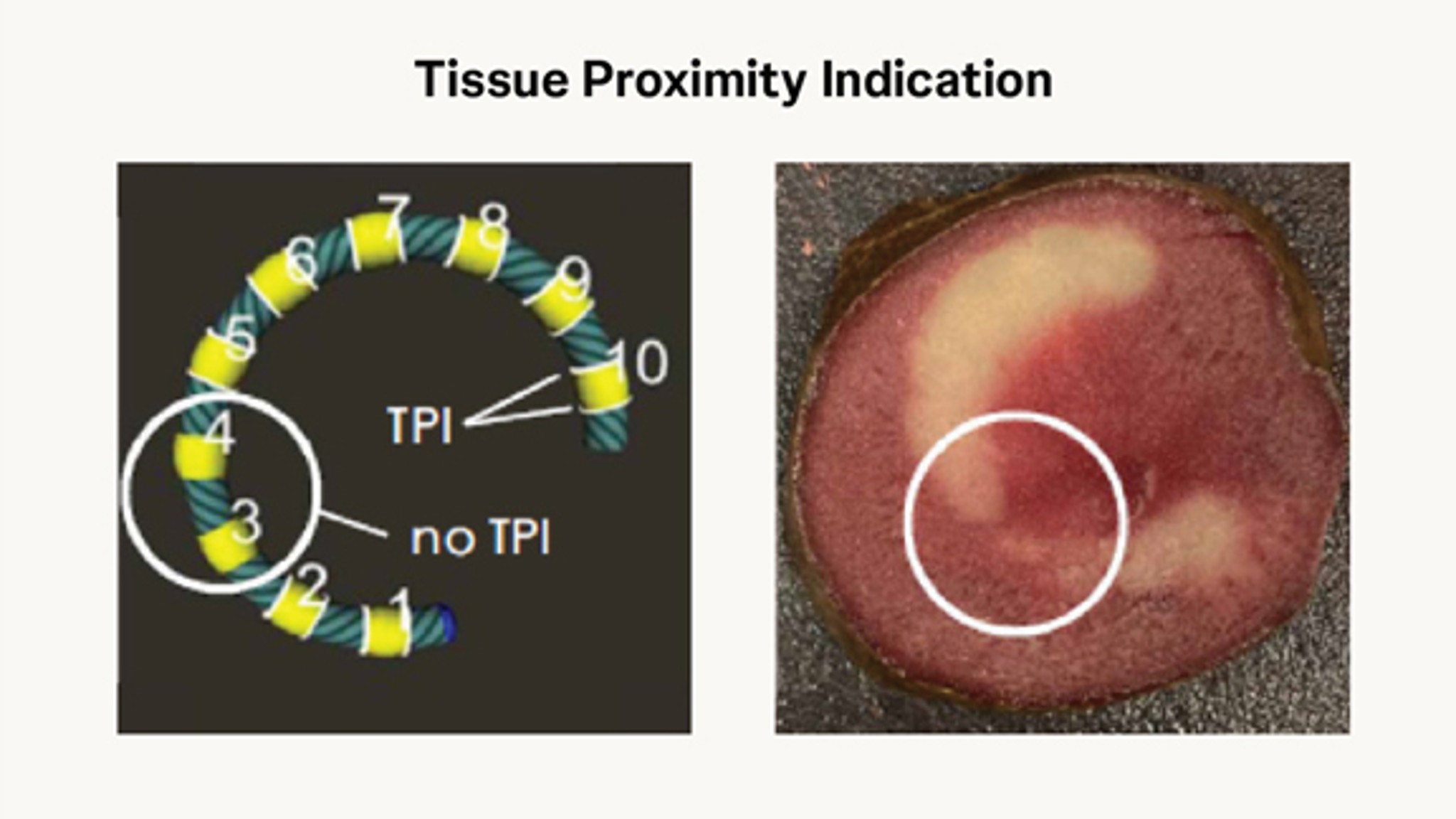 Pulsed field ablation (PFA) | J&J MedTech US