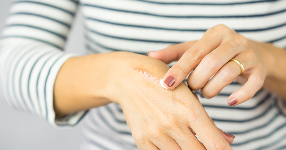 Narbenpflege leicht gemacht: Narben verbessern und pflegen