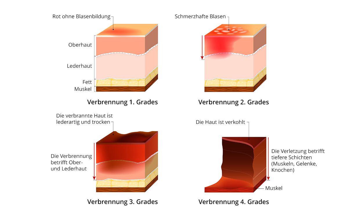 Verbrennungen Im Alltag Sofortmassnahmen Und Richtige Behandlung