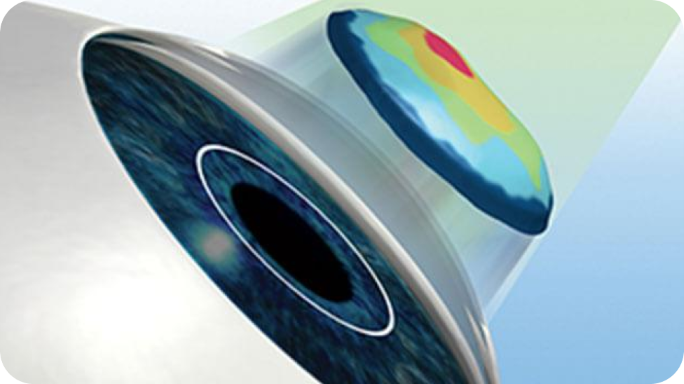 iLASIK surgery | Clear Vision For You | Johnson & Johnson