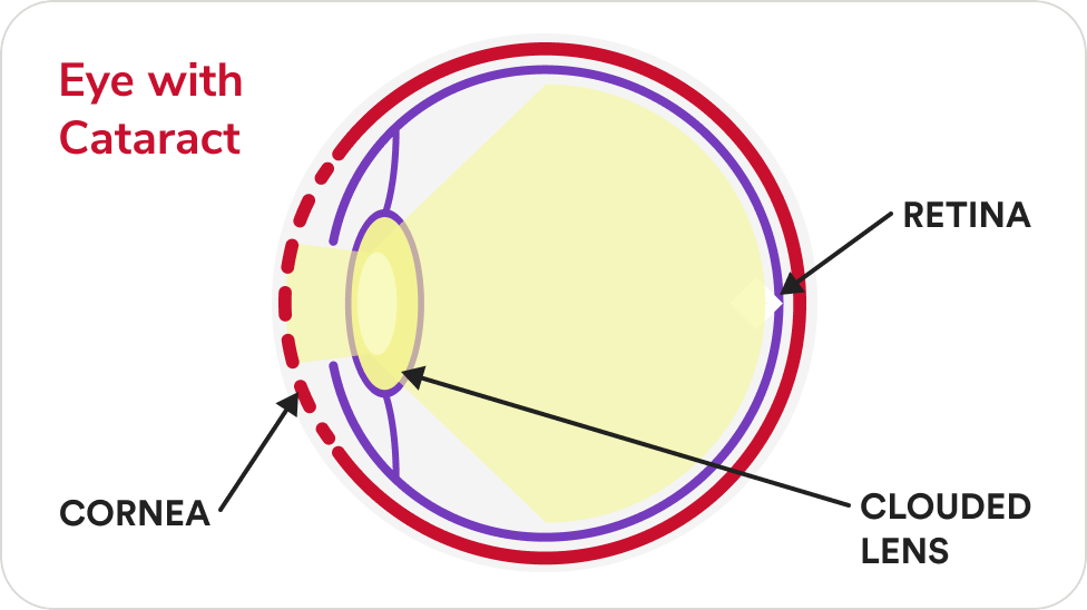 Understanding Cataracts | Clear Vision For You India