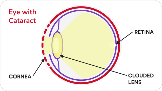 Understanding cataracts | Clear Vision For You