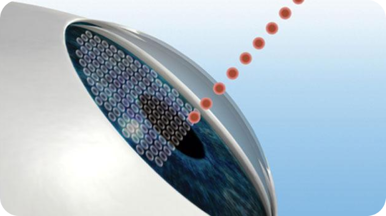 iLASIK surgery | Clear Vision For You | Johnson & Johnson