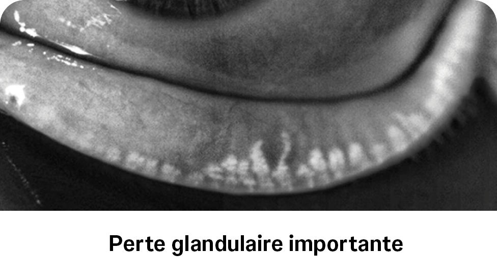 Qu'est-ce que le dysfonctionnement des glandes de Meibomius?