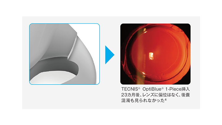 TECNIS® OptiBlue® IOL | ジョンソン・ エンド・ ジョンソン ビジョン プロフェッショナル