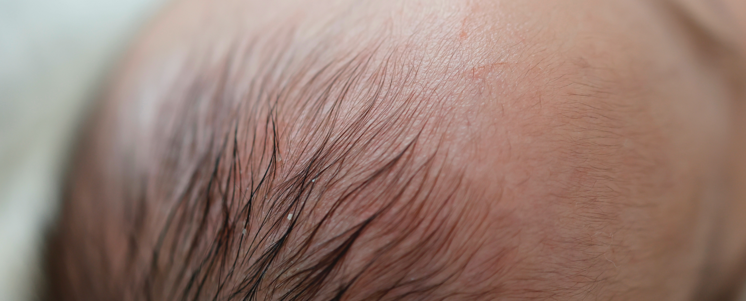 Cradle Cap: Causes and Treatments | Baby Bunting AU