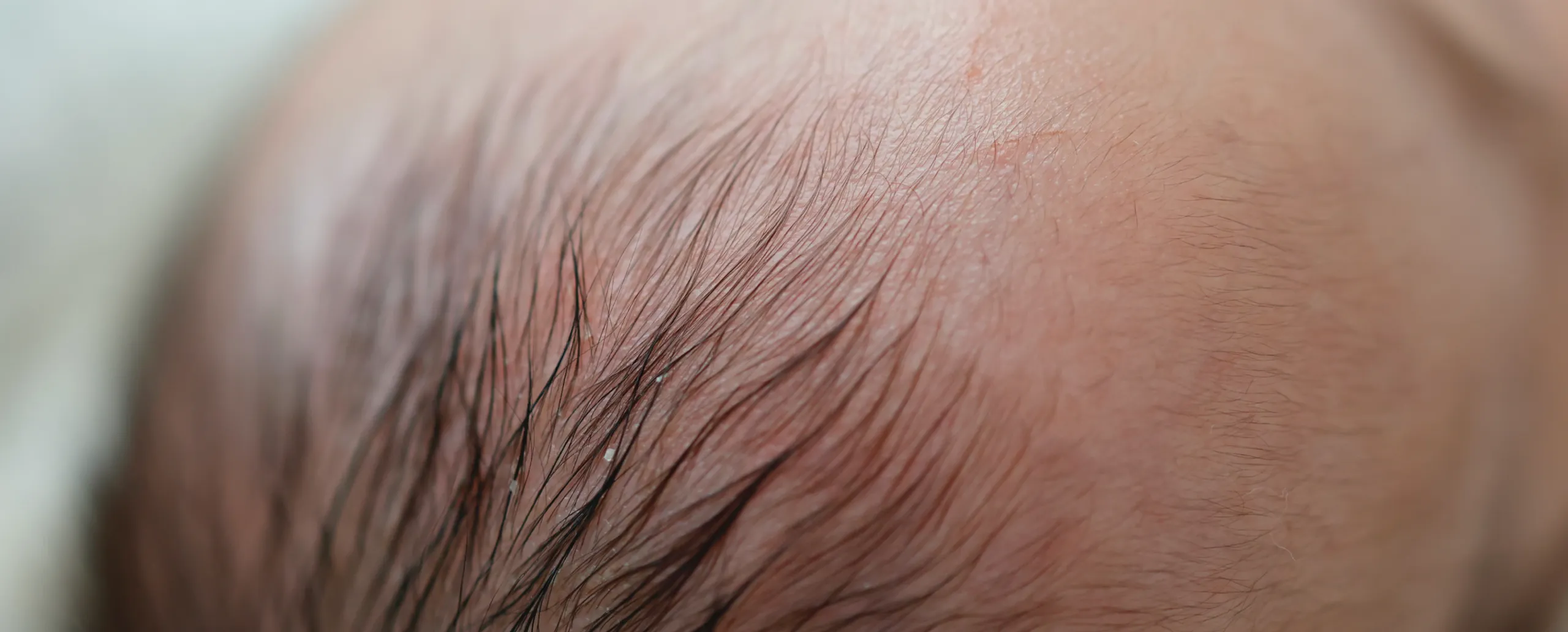 Cradle Cap: Causes and Treatments | Baby Bunting AU