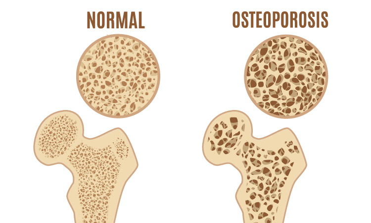 Beyond Calcium: 4 Nutrients You’re Missing for Better Bone Density ...